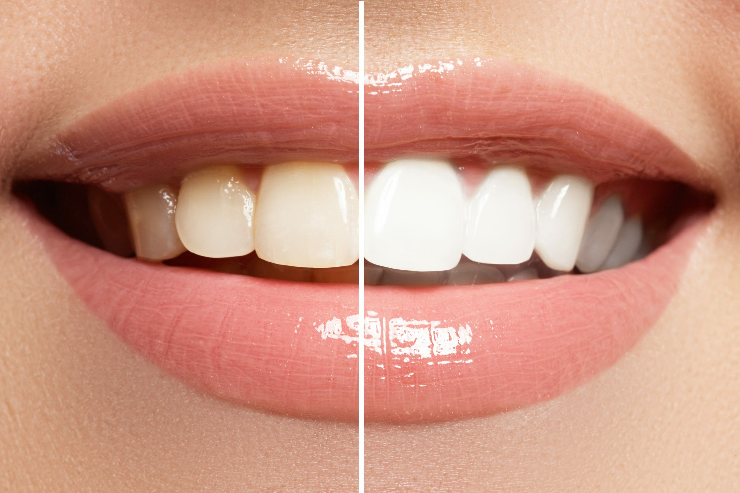 Different Types of Teeth Whitening